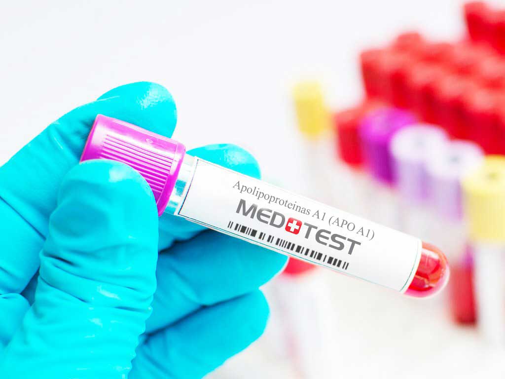 Apolipoproteinas A1 APO A1 Medtest Laboratorija Apolipoproteinas A1 APO A1 Medtest Laboratorija